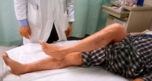 Heel-shin Test – HKU E-learning Platform in Clinical Neurosciences