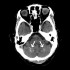 Calcifications seen on a Normal Non-contrast Cranial CT – HKU E ...