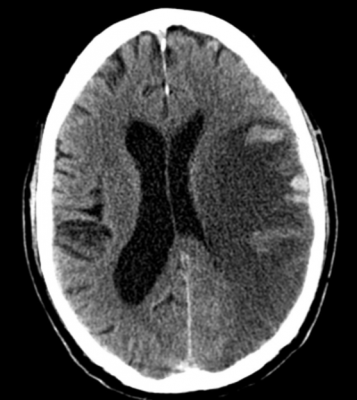 Basics of brain CT for medical students – HKU E-learning Platform in ...