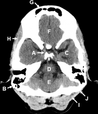 Basic anatomy of CT brain – HKU E-learning Platform in Clinical ...